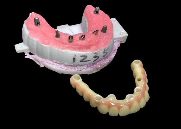 Quality Implant supported Full Arch Denture Fixed Dental implant Ceramic Crown Bridge for sale