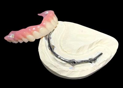 China Titanium implant supported Bar Attachment Dentures from china dental lab for sale