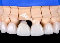 Quality Functional Aesthetic Dental Implant Crown Bridge – Precision and Durability for sale