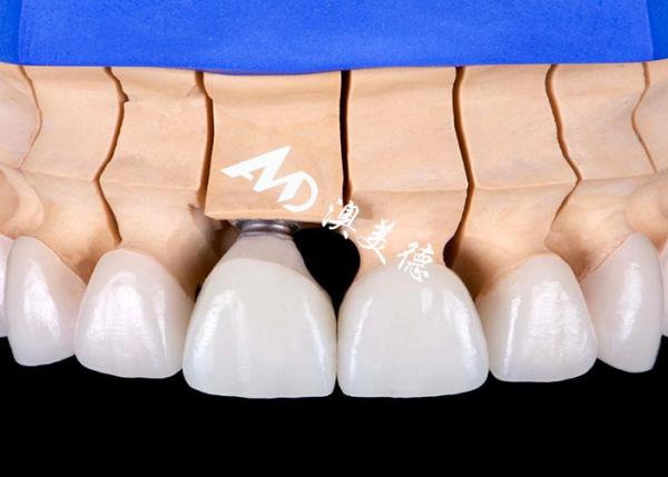 Quality Functional Aesthetic Dental Implant Crown Bridge – Precision and Durability for sale