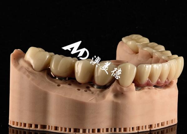 Quality Functional Aesthetic Dental Implant Crown Bridge – Precision and Durability for sale