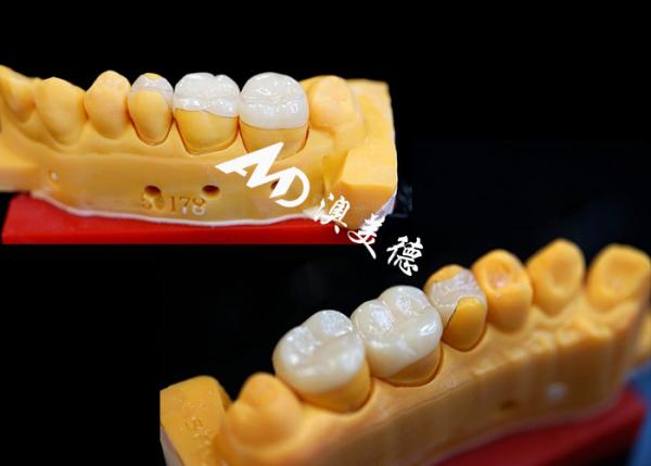 Quality OEM Precision Fit Ceramic Inlays And Onlays For Strong Natural Dental Restoratio for sale