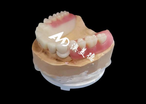 Quality Customized Hpp Frame Acrylic Removable Partial Denture For Missing Teeth for sale