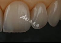 Quality Chipping Resistance Zirconia Dental Crown For Anterior Teeth / Posterior Teeth for sale