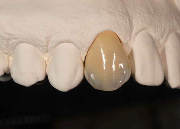 Quality Staining Resistance Solid Zirconia Crown for front teeth posterior teeth for sale
