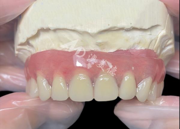 Quality Bar Attachment Dentures The Secure and Convenient Removable Denture Solution with Implant Support for sale