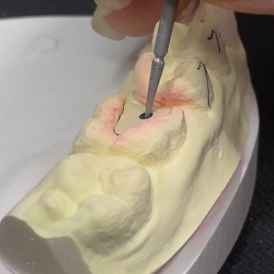 China Reinforce Your Restoration with Lock Pink Post Core Technology for sale