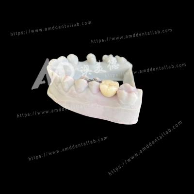 China PFM Maryland Bridge One Pontic Two Wings A Conservative and Esthetic Solution for sale