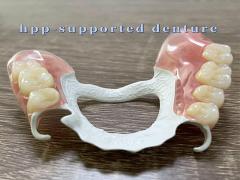 Removable Denture with HPP Frame and Acrylic Base for Enhanced Durability and Comfort