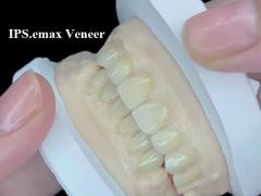 IPS e.max Veneer Premium esthetische oplossing voor prachtige glimlachtransformaties
