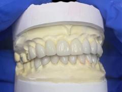 IPS EMAX porseleinen veneers voor natuurlijke voortanden