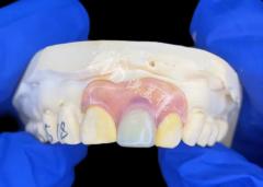 Adaptado, seguro, invisível, flexível, substituto de dentadura parital para mastigar e falar confortavelmente.