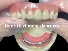 Implante de titânio apoiado em barra de fixação Dentes dentários de laboratório dentário da China
