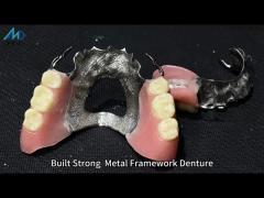 Watch: Titantium Cast Partial Dentures With Clasps Rests Along With Teeth Set Up Showcase