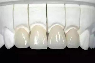China Metal 3d Printing PFM Denture And False Teeth for sale