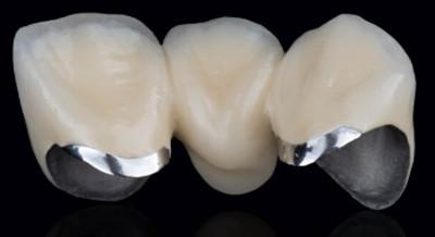 China Porcelain-Fused-to-Metal (PFM) Crowns Dental laboratories China for sale