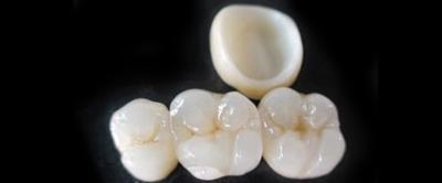 China Full Porcelain Crowns China Dental Laboratory for sale
