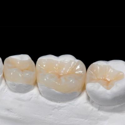 China PFM Ceramic Crowns Zirconia Metal Crown China Dental Lab for sale