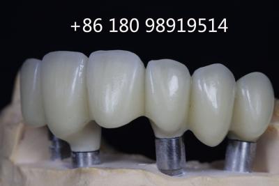 China Total Implant PFM Bridge China Dental Lab for sale