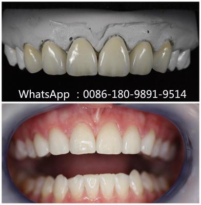 China Digital CAD CAM Dental Lab Crowns Translucent Layered Zirconia Crown for sale