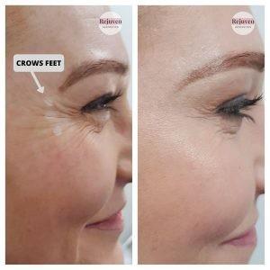 중국 2.5ml 식염수 주사 보툴리눔 독소 노화 방지 보톡스 판매용