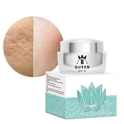 China Remove Acne Pimple Marks Cream for Anti Freckle Acne Clear for sale
