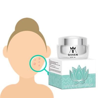 China Pimple Freckle Removal Cream for Acne Clear Pimple Treatment for sale