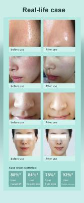 China Limpieza profunda de la burbuja de la máquina de Hydrafacial del oxígeno de Dermabrasion 65Khz en venta