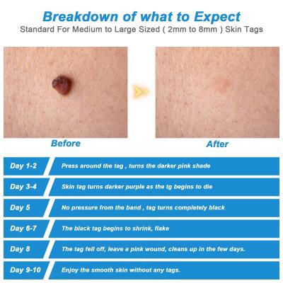 Cina Chiaro ODM automatico tenuto in mano di Kit Stopping Skin Tags Blood del dispositivo di rimozione dell'etichetta della pelle in vendita