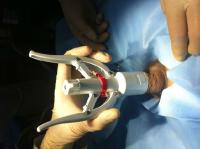 China Disposable Circular Visual Circumcision Device 15mm Male Circumcision Stapler for sale