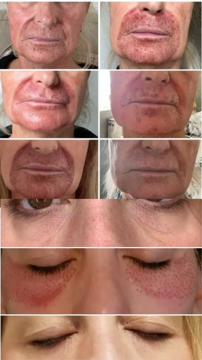 10 in 1 Cold and Warm Plasma Skin Rejuvenation Improve Fine Lines Jet Face Body Care Wrinkle Removal Plasma Machine