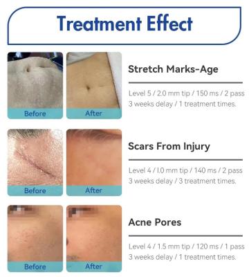 China Radiofrequência fracionária e micro-agulha Rf máquina de ouro Microneedling pele de levantamento e aperto de equipamentos à venda