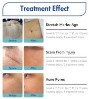 China Wrinkle Removal Secret RF Machine for sale