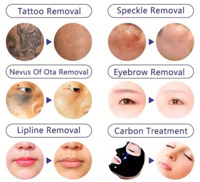 China Portable Pico Second Laser Tattoo Remover Q Switched Nd Yag Picosecond Tätowierungsmaschine zu verkaufen