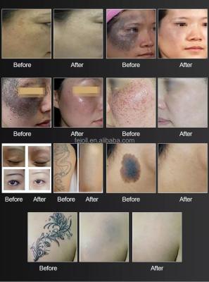 China Q Schakel tatoeageverwijder en koolstof peeling apparatuur Nd Yag laser Qswitch tatoeage verwijdering machine Te koop
