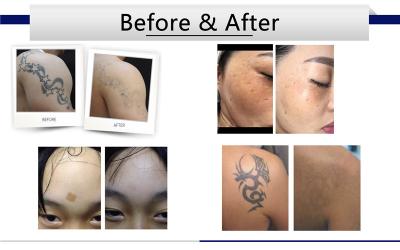 China Q-Switched Nd Yag Laser 1064 1320 532 nm remoção de tatuagens peeling de carbono máquina de beleza portátil à venda