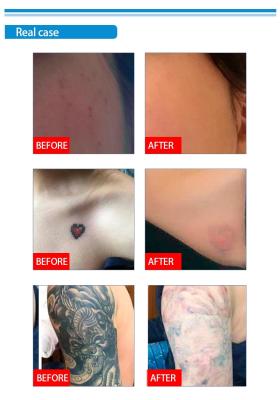 Cina Macchina di peeling di carbonio per la rimozione del tatuaggio con laser in vendita