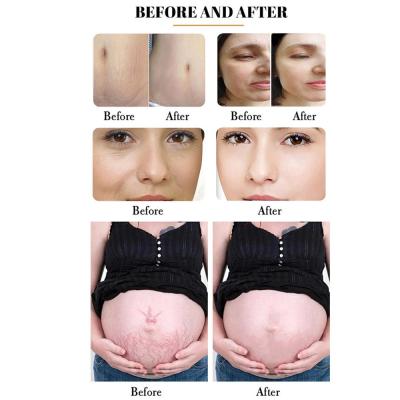 China Rejuvenescimento da pele Equipamento de beleza Aprigar Vaginal Máquina de laser fracionada de CO2 à venda