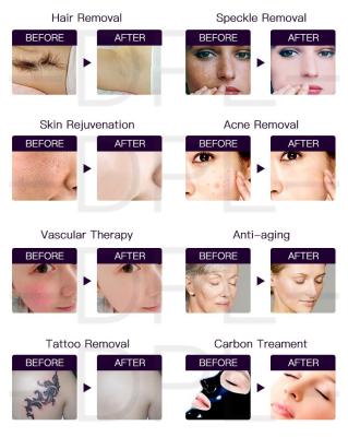 China 2021 Multiifunção Laser IPL OPT depilação Facial RF Tratamento de acne Nd Yag Laser Tattoo máquina de depilação indolor à venda