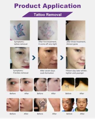 China Portable Q Switched Pico Laser Machine 1064nm Tattoo Entfernung Schönheitsgerät Fabrik zu verkaufen