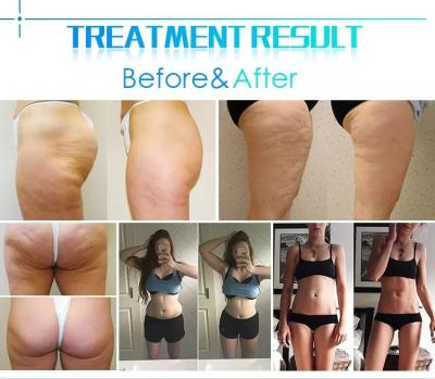 China Infrared rf vacuum roller body slimming fat reduction skin tightening face skin lifting machine for sale