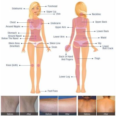 Cina Depilazione stazionaria 808nm Alma Hair Removal Laser del laser dell'alessandrite DPL in vendita
