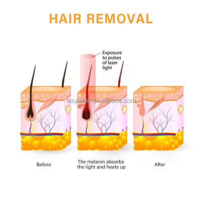 Cina Depilazione stazionaria 808nm Alma Hair Removal Laser del laser dell'alessandrite DPL in vendita