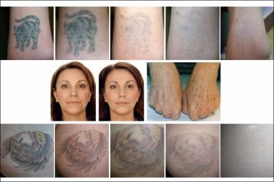 Cina Rimozione permanente del tatuaggio della macchina 755nm del laser di picosecondo del sopracciglio del salone in vendita