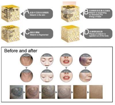 Cina Attrezzatura del laser del tatuaggio della macchina 755nm del laser di picosecondo di Melasma dell'alessandrite in vendita