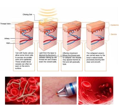 Cina Dispositivo domestico di terapia laser di uso della cura dell'onicomicosi di Toe Nail Fungus Fungal Remover in vendita