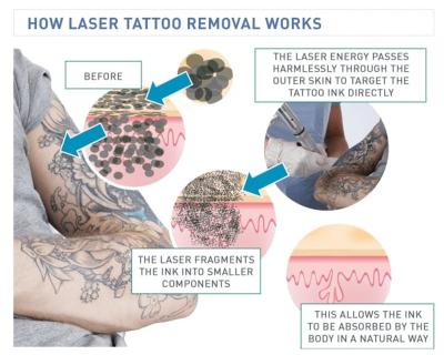 Cina Ringiovanimento della pelle della macchina di rimozione del tatuaggio del laser di picosecondo del ND YAG del commutatore di Q in vendita