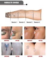 China Microblading Q Switch Nd Yag Laser for sale