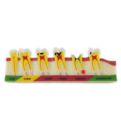 China Dental Peridontal Diseases Developing Model for sale