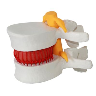 Cina Vertebre 3D Spina cervicale Modello 1.5X Ernia lombare della colonna vertebrale in vendita